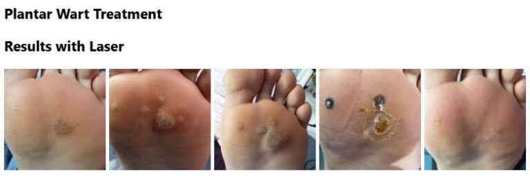 Plantar Wart Treatment Case Study 2 Laser Wart Treatment Wart