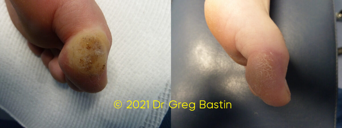 Blog - Laser Wart Treatment | Wart Specialist | Plantar Warts Melbourne