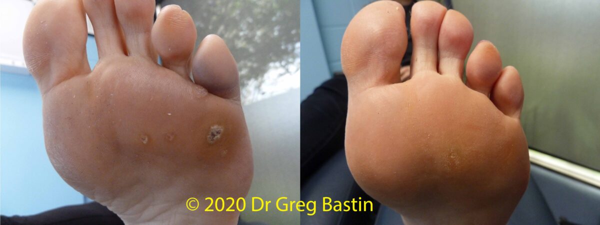 How to Remove Warts: The Journey to Expertise