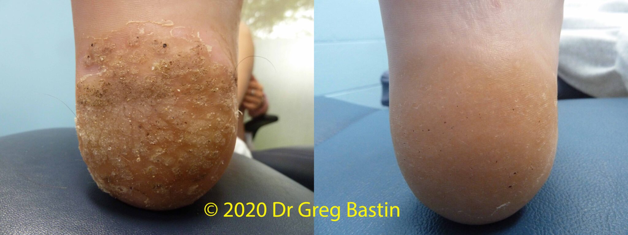 Wart Laser Clinic Brighton: Revolutionizing Wart Treatment with Cutting ...